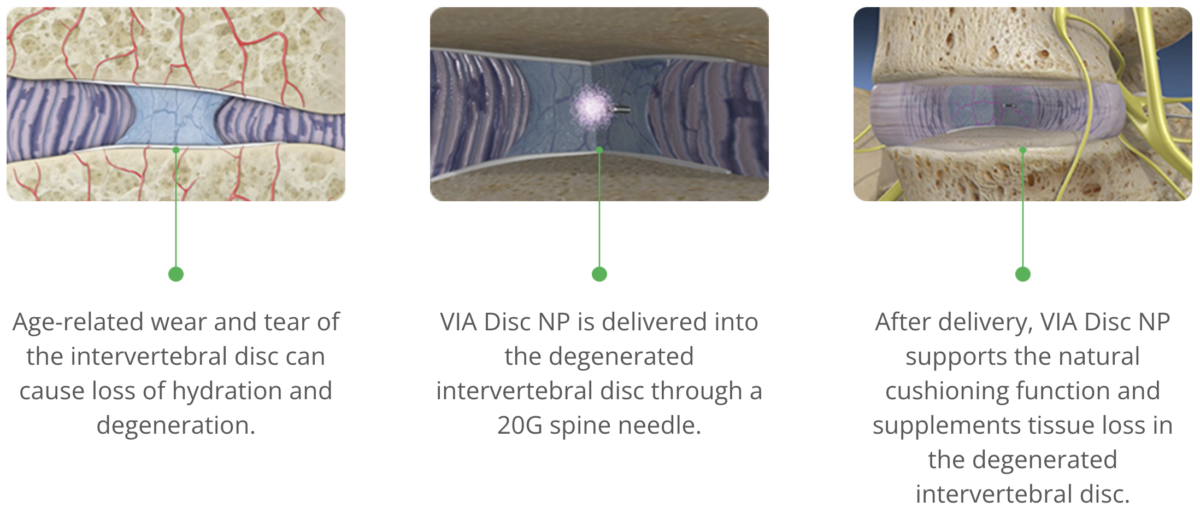 VIA Disc NP | The Spine Diagnostic & Pain Treatment Center