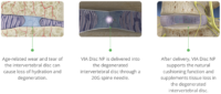 VIA Disc NP | The Spine Diagnostic & Pain Treatment Center