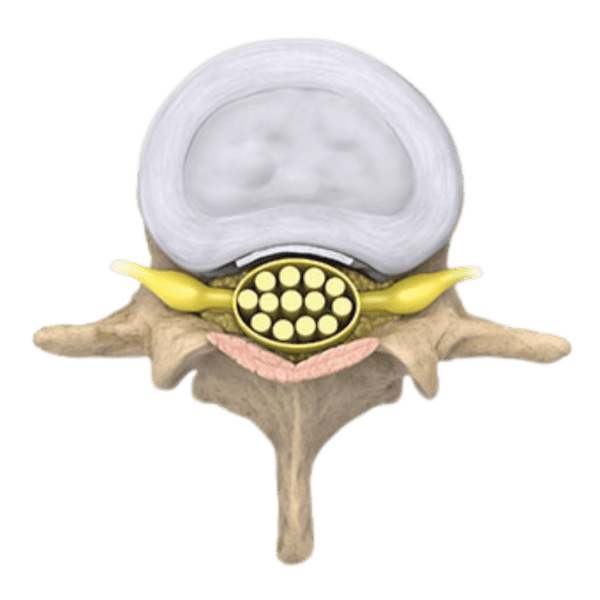 mild® Procedure | The Spine Diagnostic & Pain Treatment Center