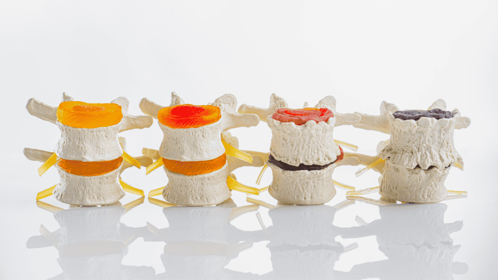 ViaDisc: An Effective Treatment for Degenerative Disc Disease | The ...